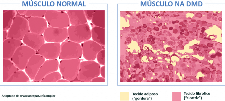 O que é Distrofia Muscular de Duchenne (DMD)? – Movimento Duchenne